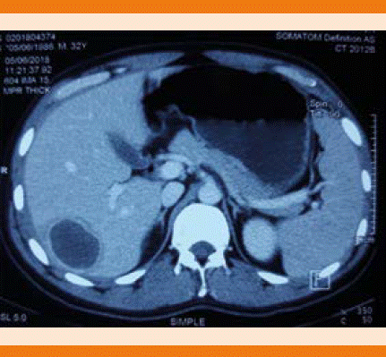 Hemoglobinuria paroxística nocturna y absceso hepático: asociación poco ...